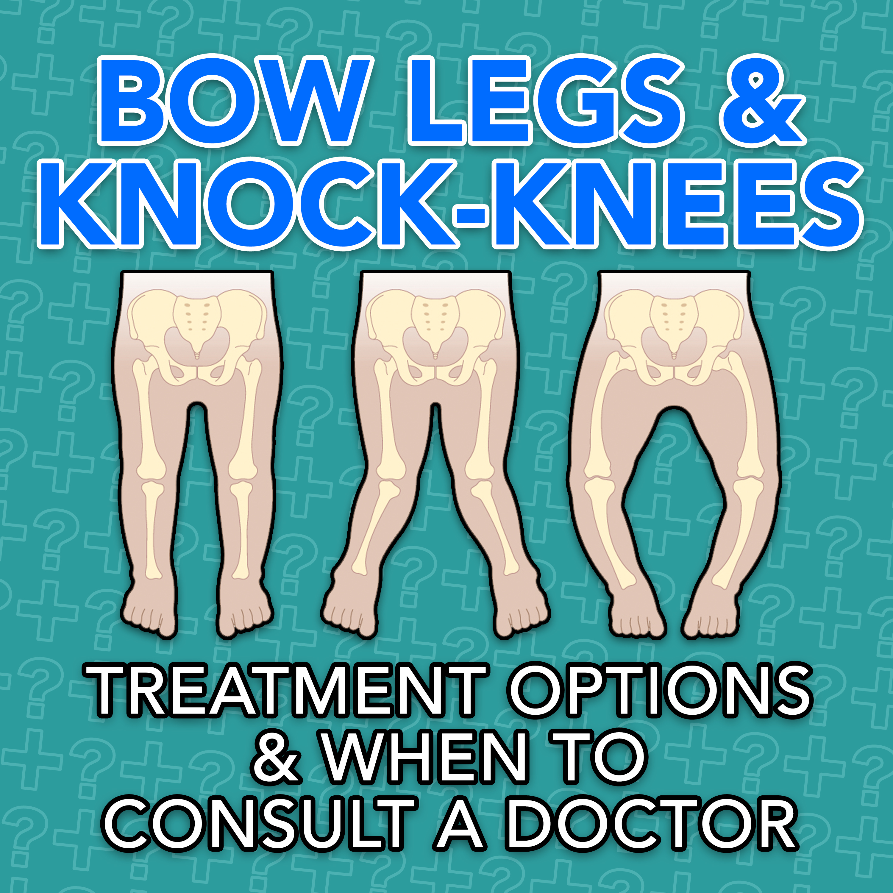Bow Legs & Knock-Knees: Treatment Options & When to Consult a Doctor ...